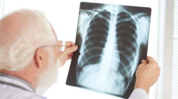 Obostrana upala pluća: Ozbiljna infekcija koja može biti fatalna